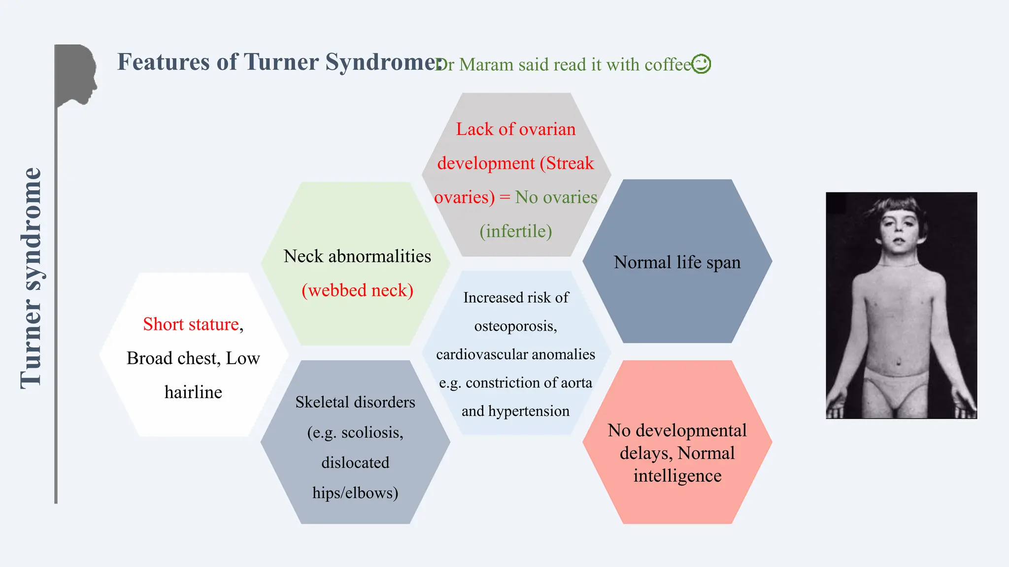 1-Klinefelter, Turner and Down Syndromes.pptx