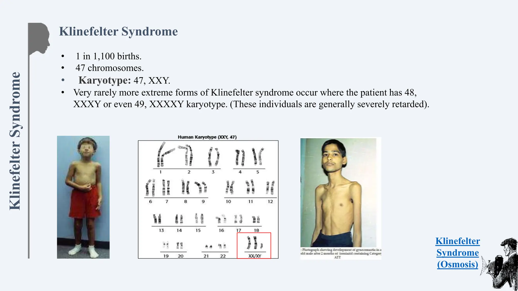 1-Klinefelter, Turner and Down Syndromes.pptx