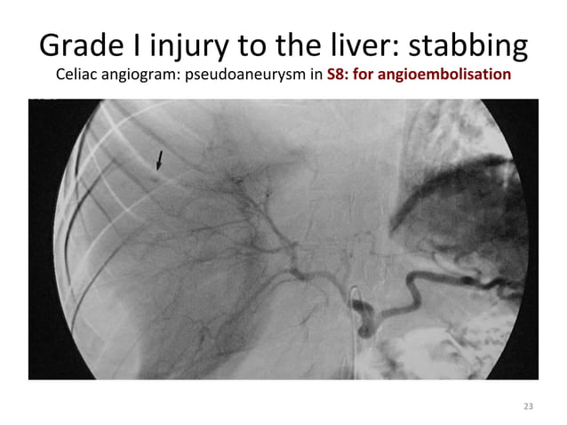 Management of liver trauma in adults, 2018, by R. Lunevicius | PDF