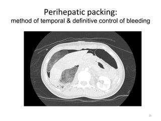 Liver trauma: operative management, 2018, by R. Lunevicius | PDF