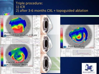 Dr. Lovisolo "The Triple Procedure: ICR + tomo-linked PTK + CXL" | PPT