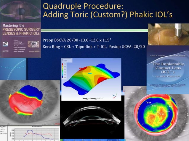 Dr. Lovisolo "The Triple Procedure: ICR + tomo-linked PTK + CXL" | PPT