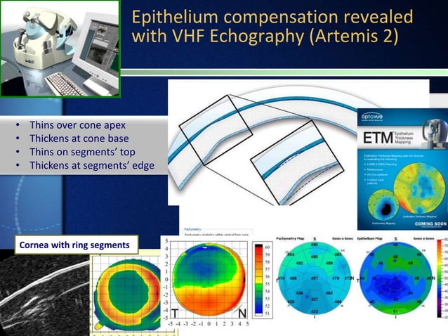 Dr. Lovisolo "The Triple Procedure: ICR + tomo-linked PTK + CXL" | PPT
