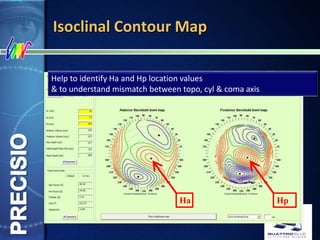 Dr. Lovisolo "The Triple Procedure: ICR + tomo-linked PTK + CXL" | PPT