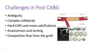 Flash Debate: To coil or not coil the graft in post-CABG | PDF