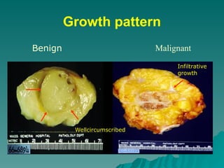 1 - Neoplasia Definition Types & Characteristics, Nomenclature (1).pptx