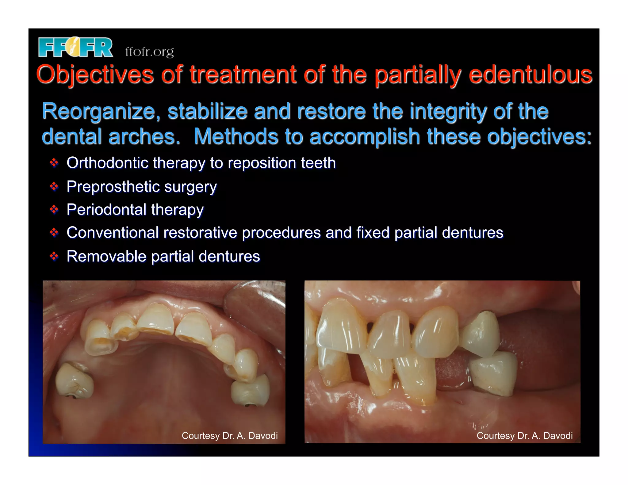 1.(new)introduction and basic components of rpd's | PDF