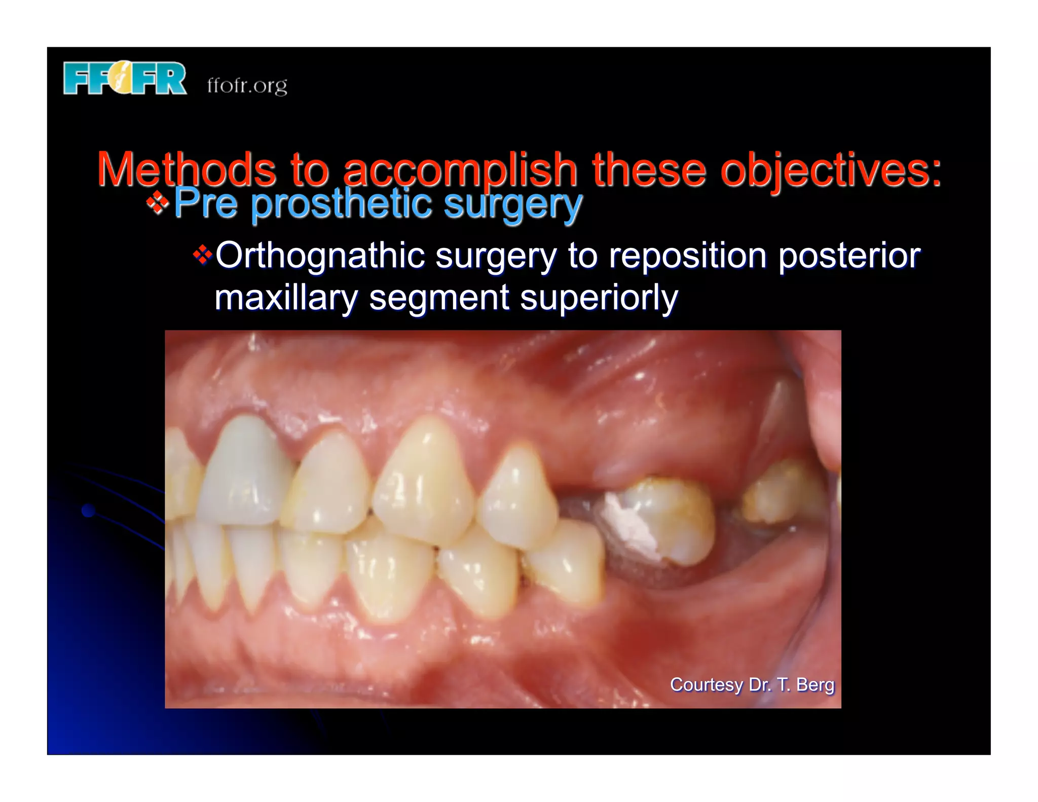 1.(new)introduction and basic components of rpd's | PDF