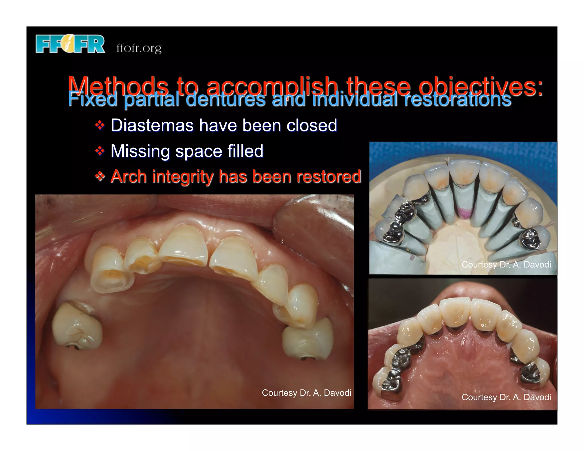 1.(new)introduction and basic components of rpd's | PDF