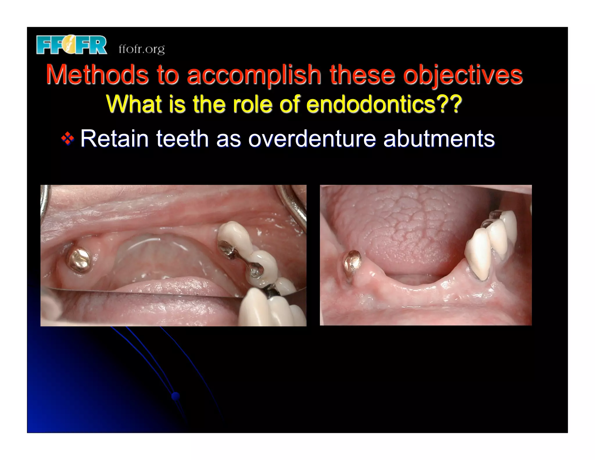 1.(new)introduction and basic components of rpd's | PDF