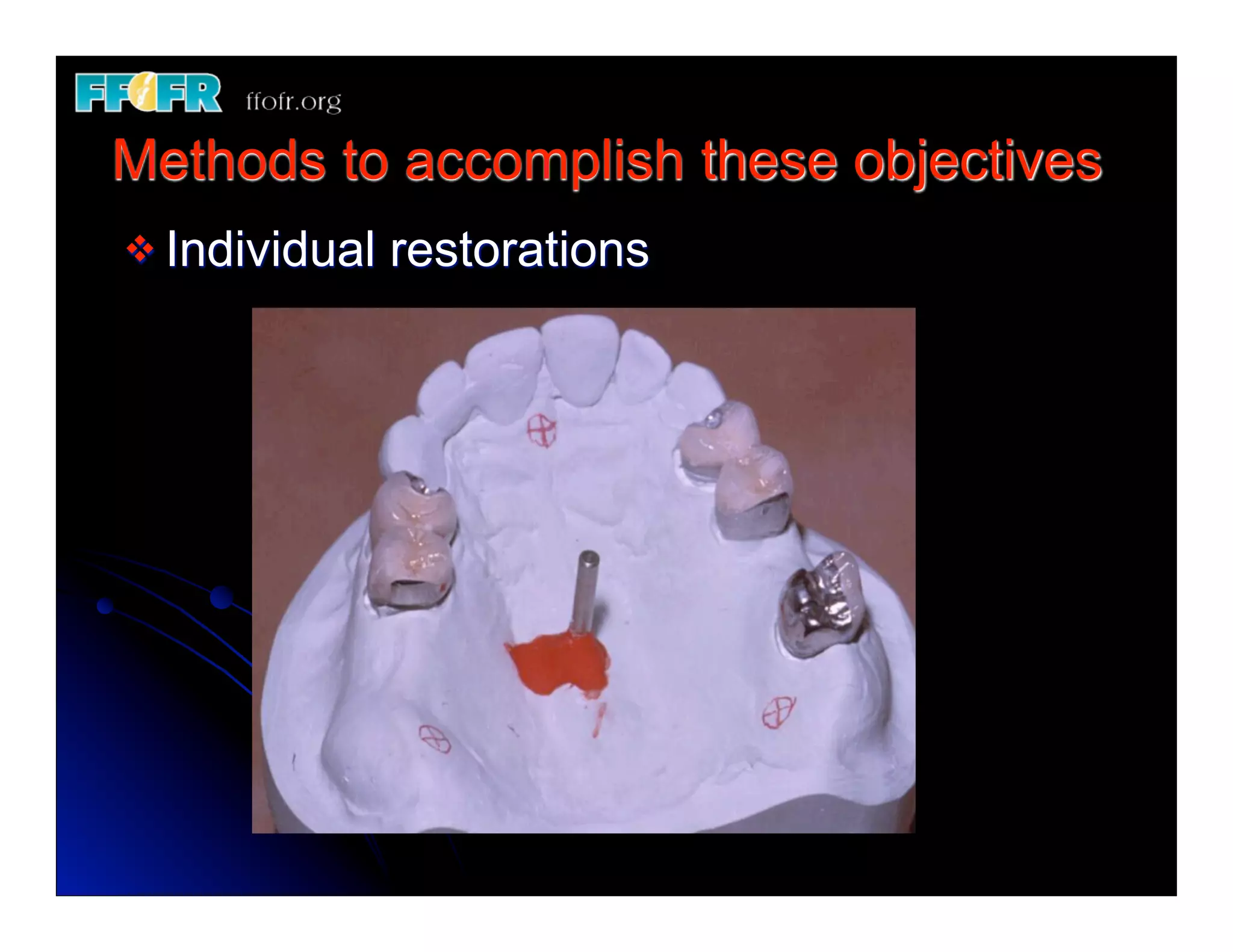 1.(new)introduction and basic components of rpd's | PDF