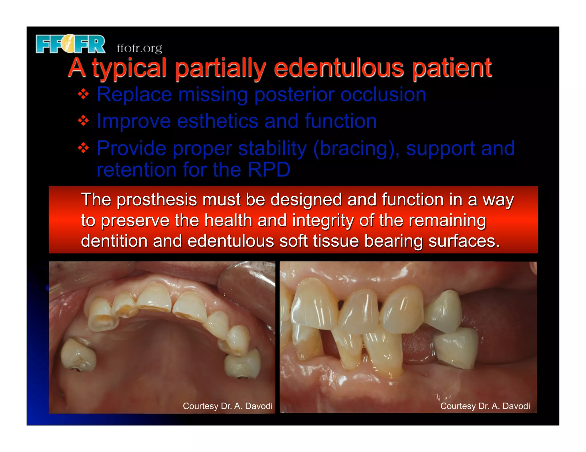 1.(new)introduction and basic components of rpd's | PDF