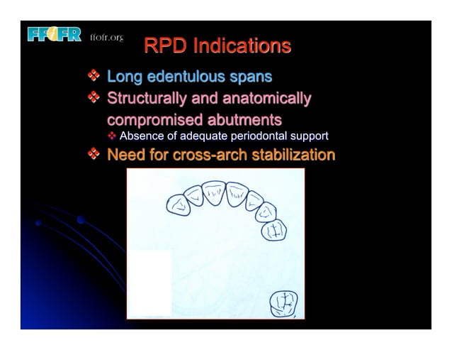1.(new)introduction and basic components of rpd's | PDF | Dental Health ...