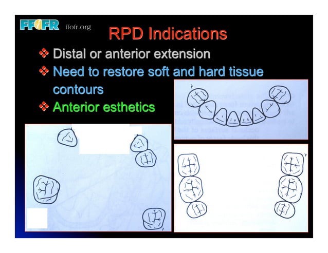 1.(new)introduction and basic components of rpd's | PDF | Dental Health ...