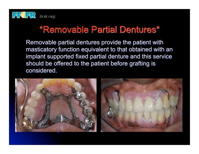 1.(new)introduction and basic components of rpd's | PDF | Dental Health ...