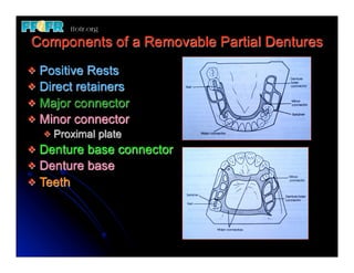 1.(new)introduction and basic components of rpd's | PDF