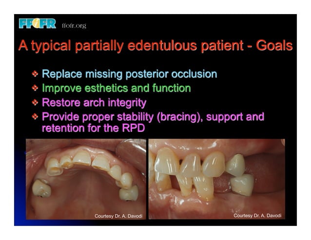 1.(new)introduction and basic components of rpd's | PDF | Dental Health ...