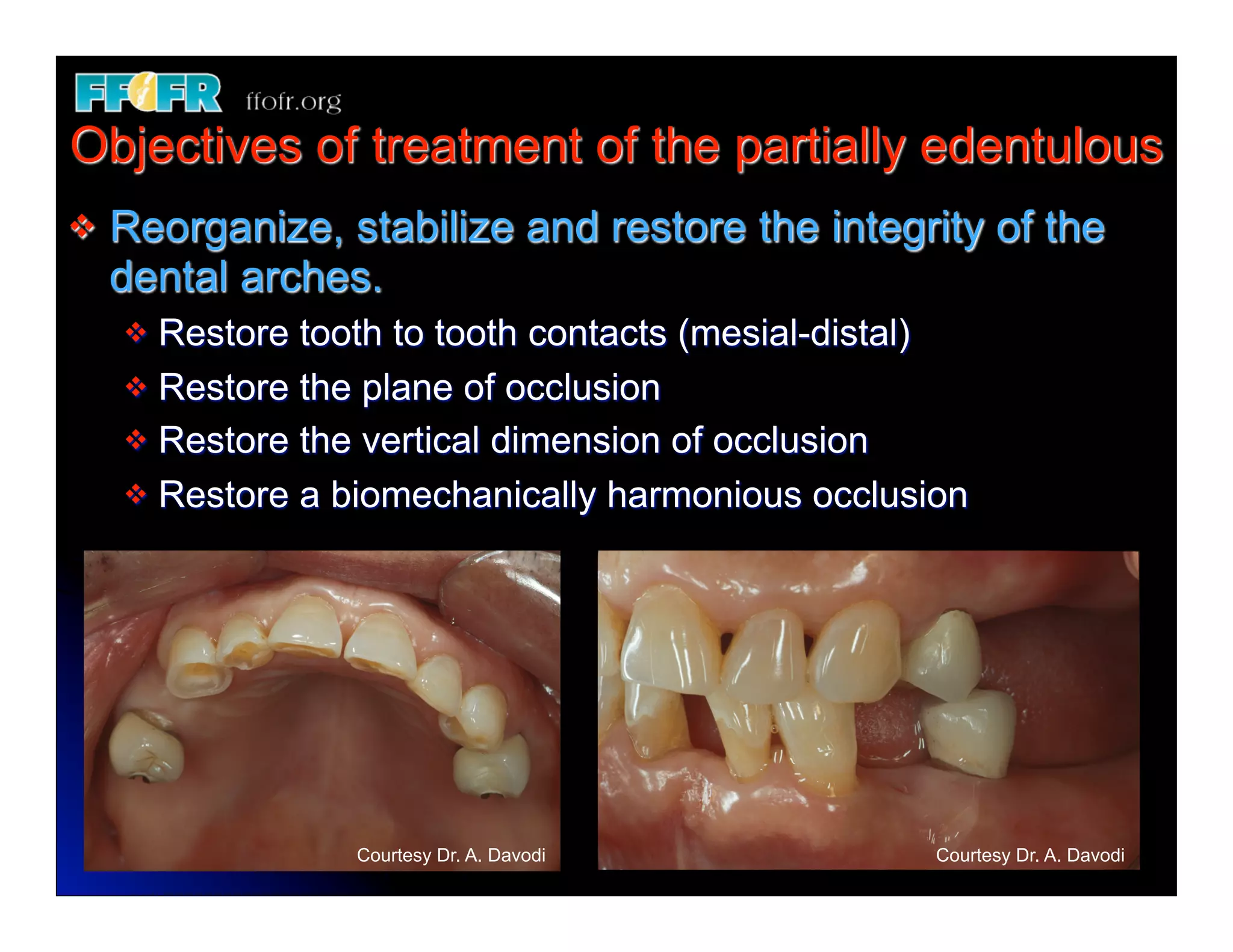 1.(new)introduction and basic components of rpd's | PDF | Dental Health ...