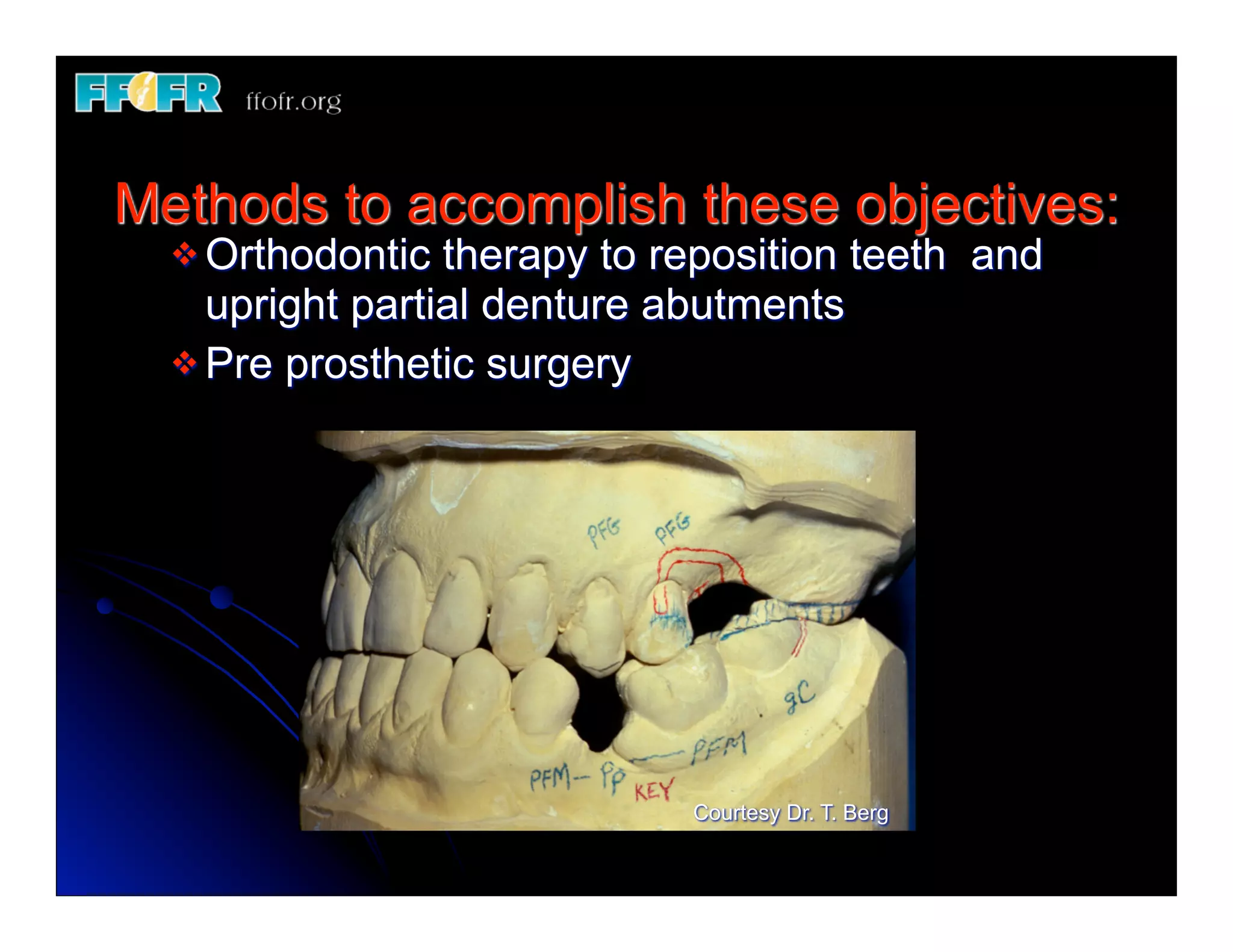 1.(new)introduction and basic components of rpd's | PDF | Dental Health ...