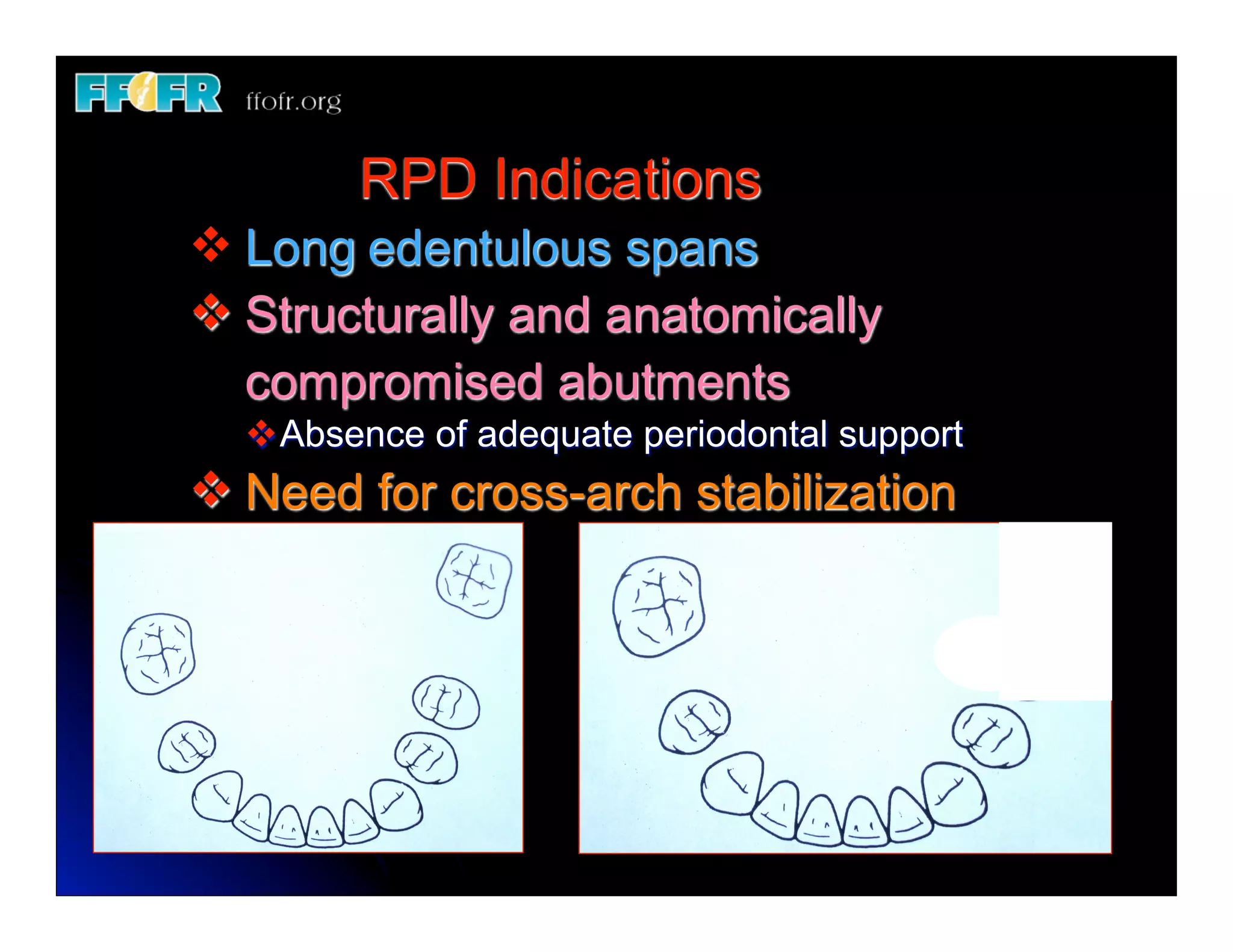 1.(new)introduction and basic components of rpd's | PDF | Dental Health ...