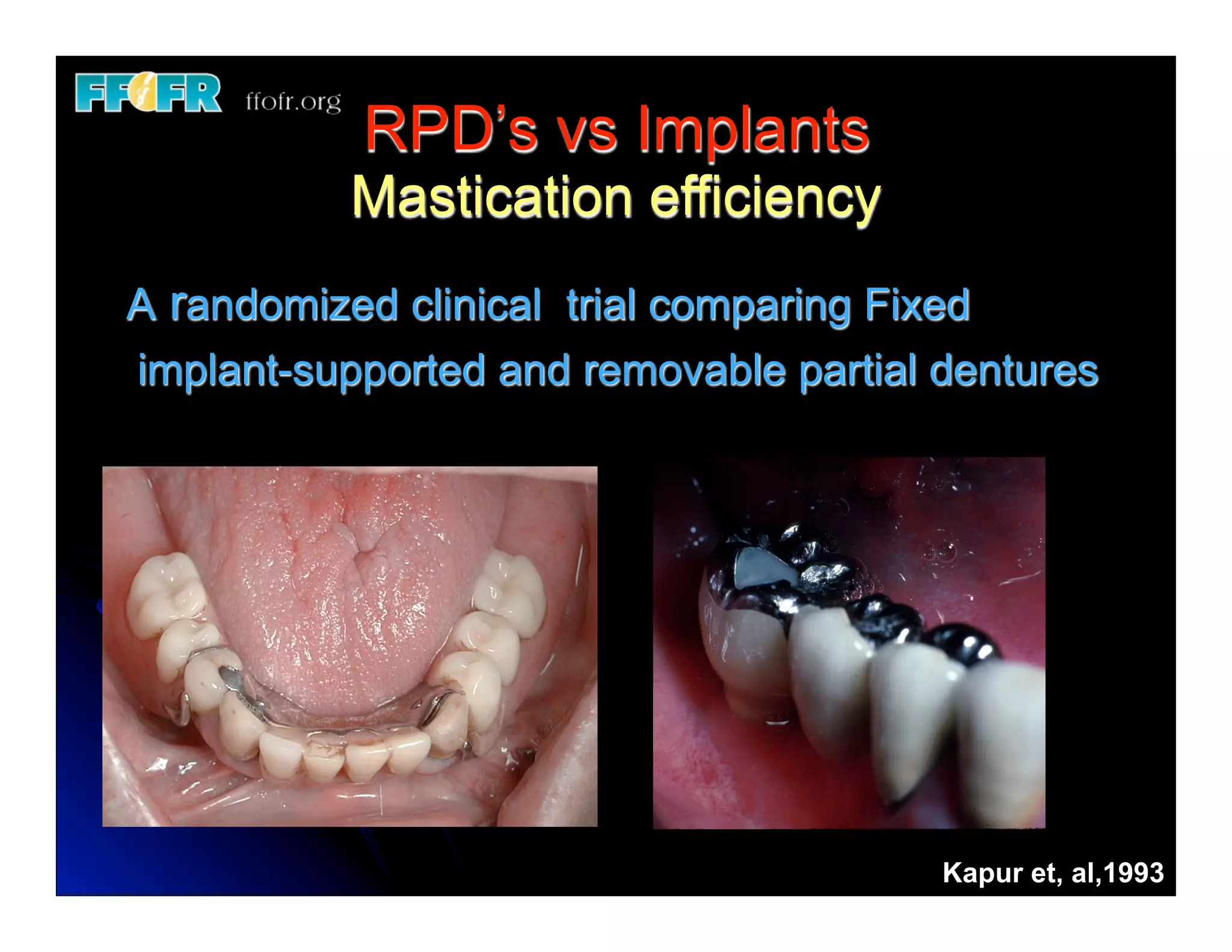 1.(new)introduction and basic components of rpd's | PDF | Dental Health ...
