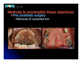 1.(new)introduction and basic components of rpd's | PDF