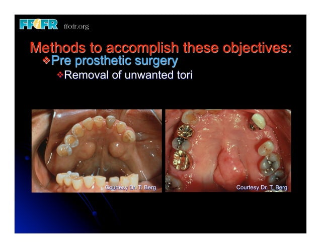 1.(new)introduction and basic components of rpd's | PDF | Dental Health ...