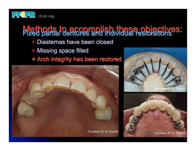 1.(new)introduction and basic components of rpd's | PDF | Dental Health ...