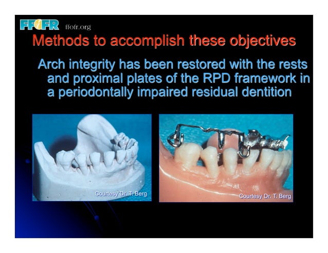 1.(new)introduction and basic components of rpd's | PDF | Dental Health ...
