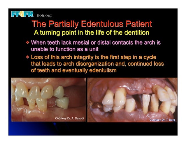 1.(new)introduction and basic components of rpd's | PDF | Dental Health ...
