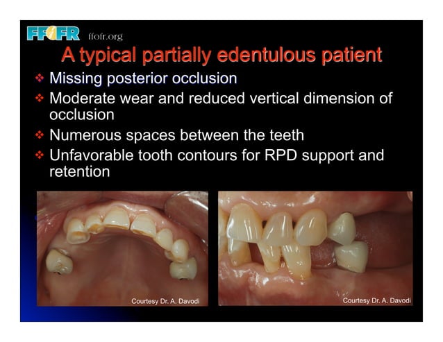 1.(new)introduction and basic components of rpd's | PDF | Dental Health ...