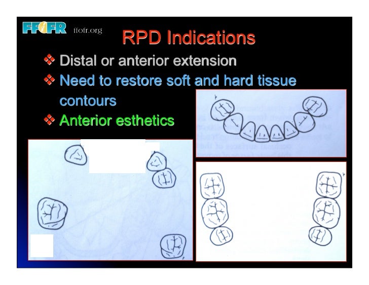 1.(new)introduction and basic components of rpd's