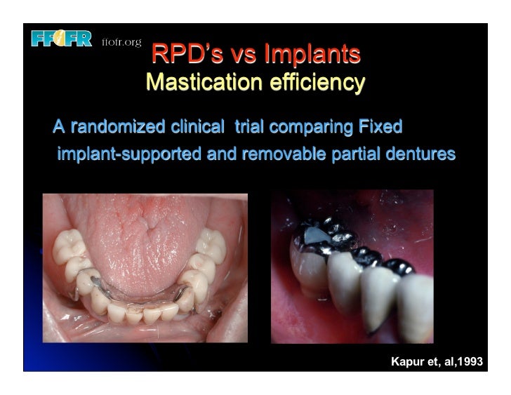 1.(new)introduction and basic components of rpd's