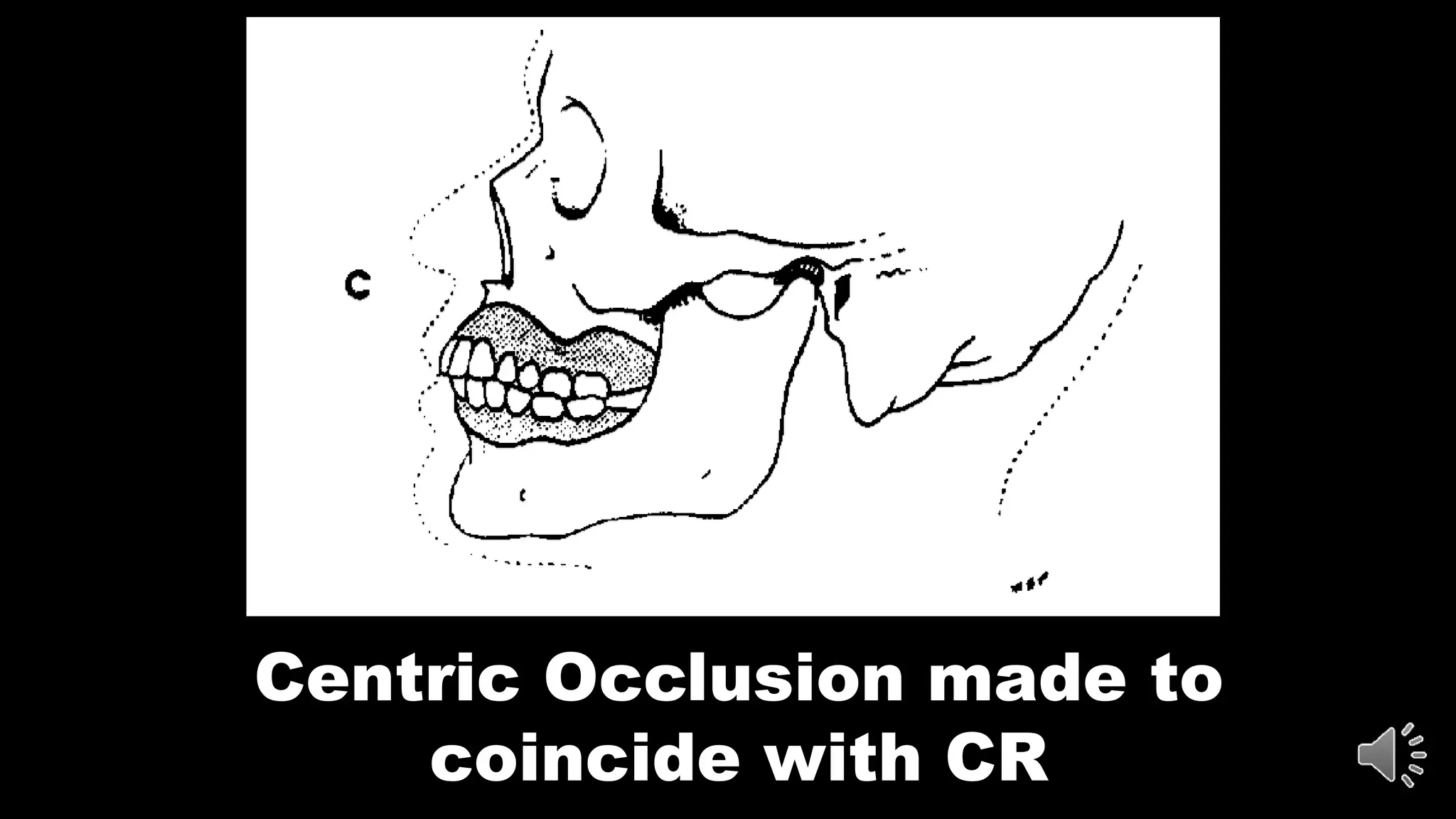 1 Occlusion in prosthodontics- introduction- differences between ...