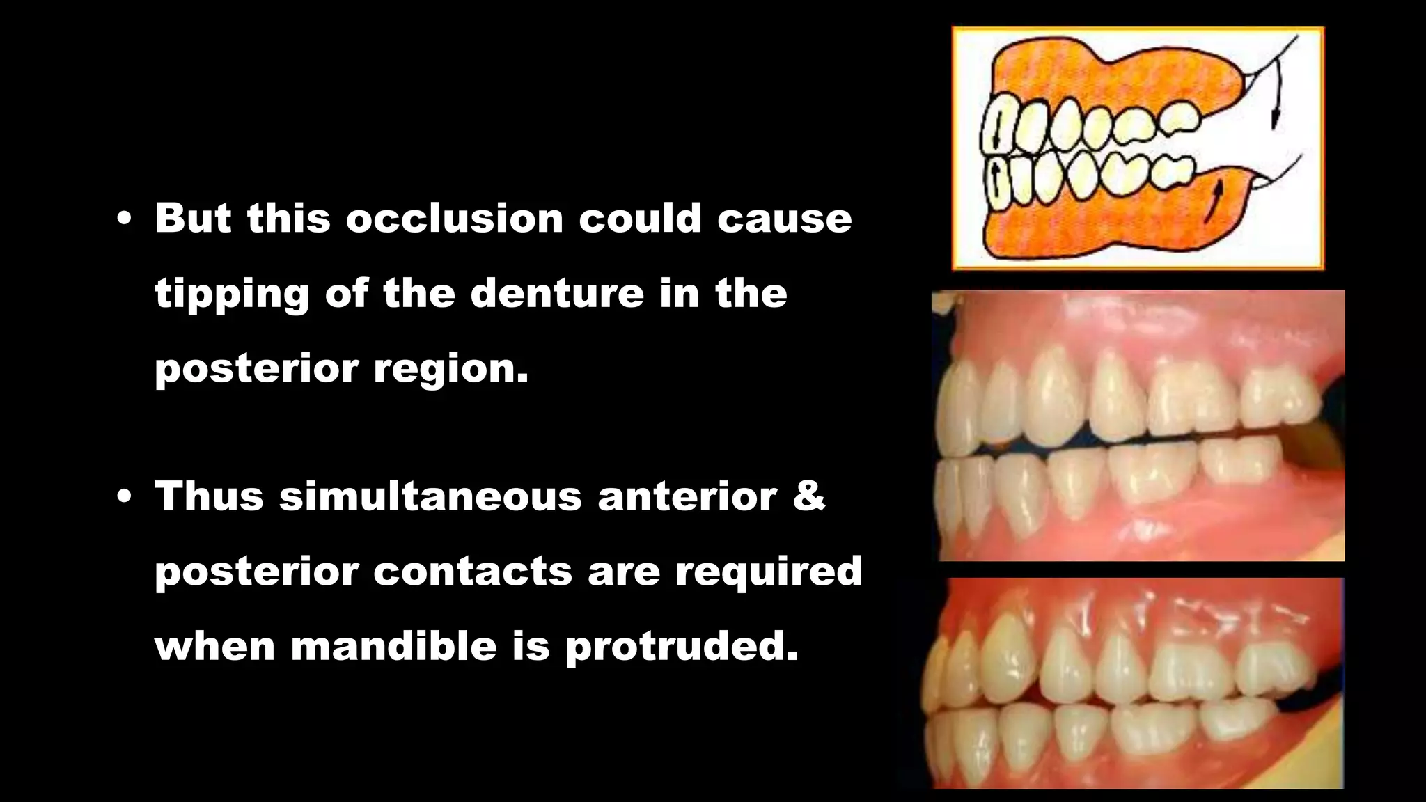 1 Occlusion in prosthodontics- introduction- differences between ...