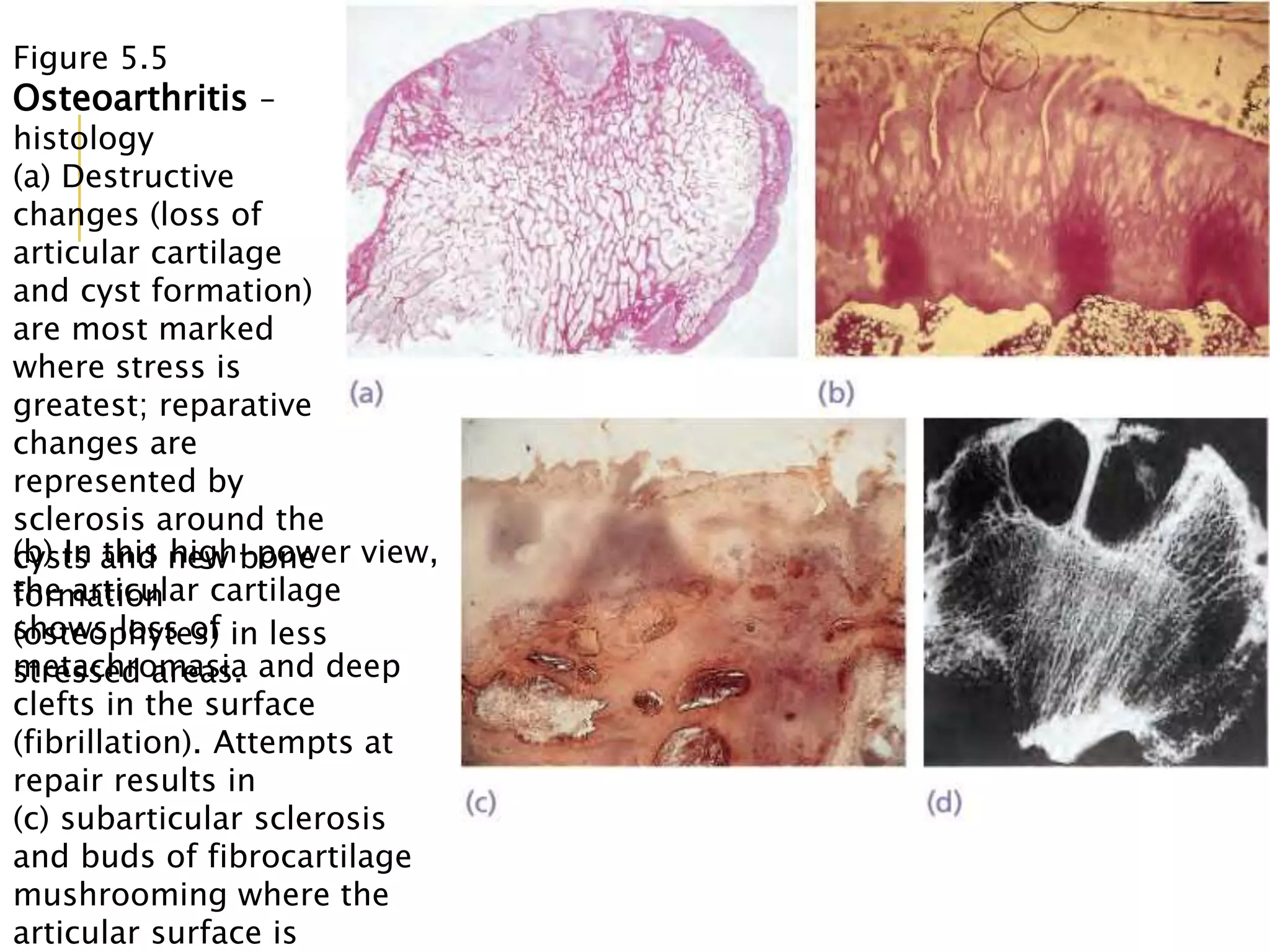 Osteoarthritis.pptx