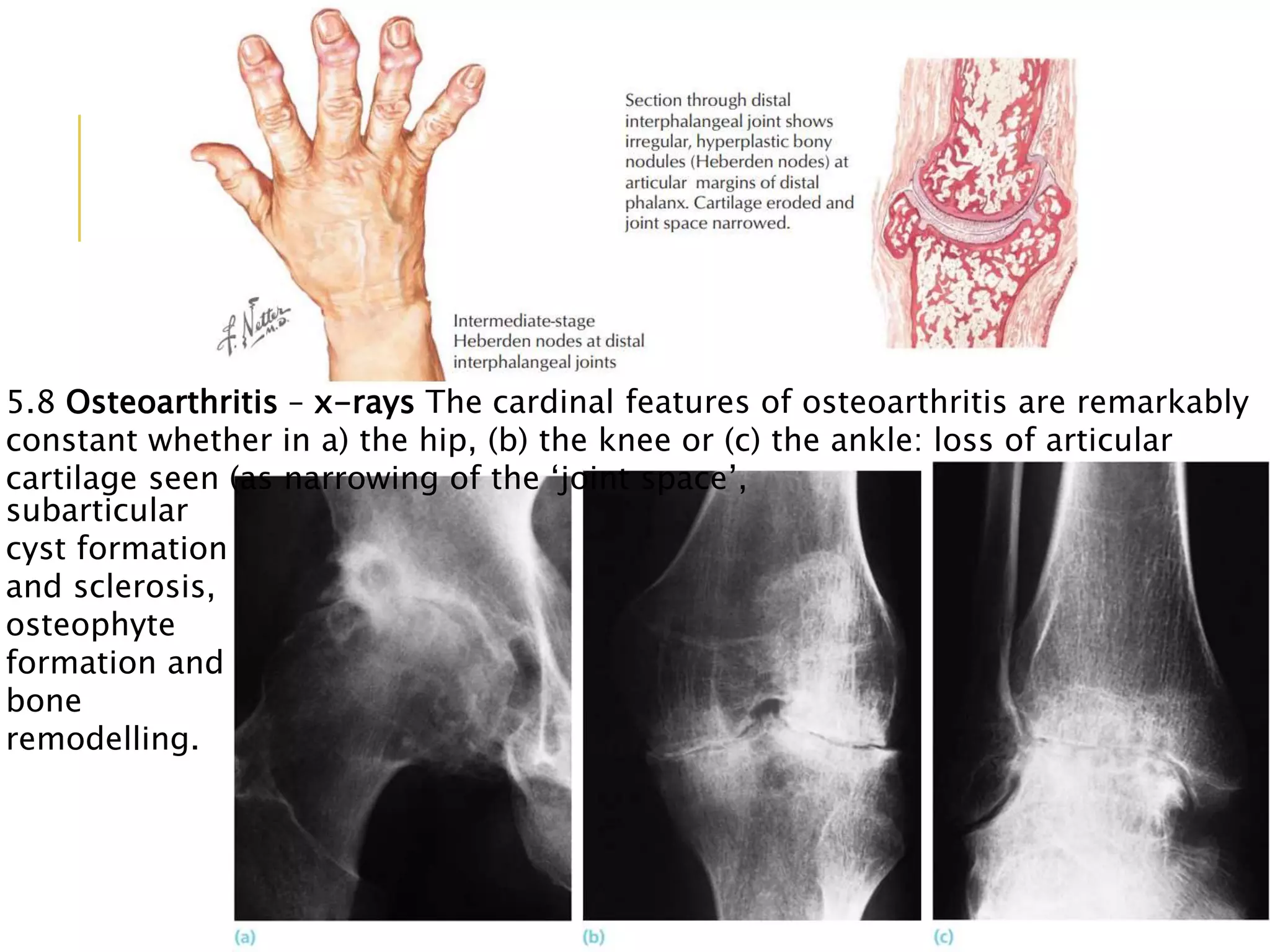 Osteoarthritis.pptx