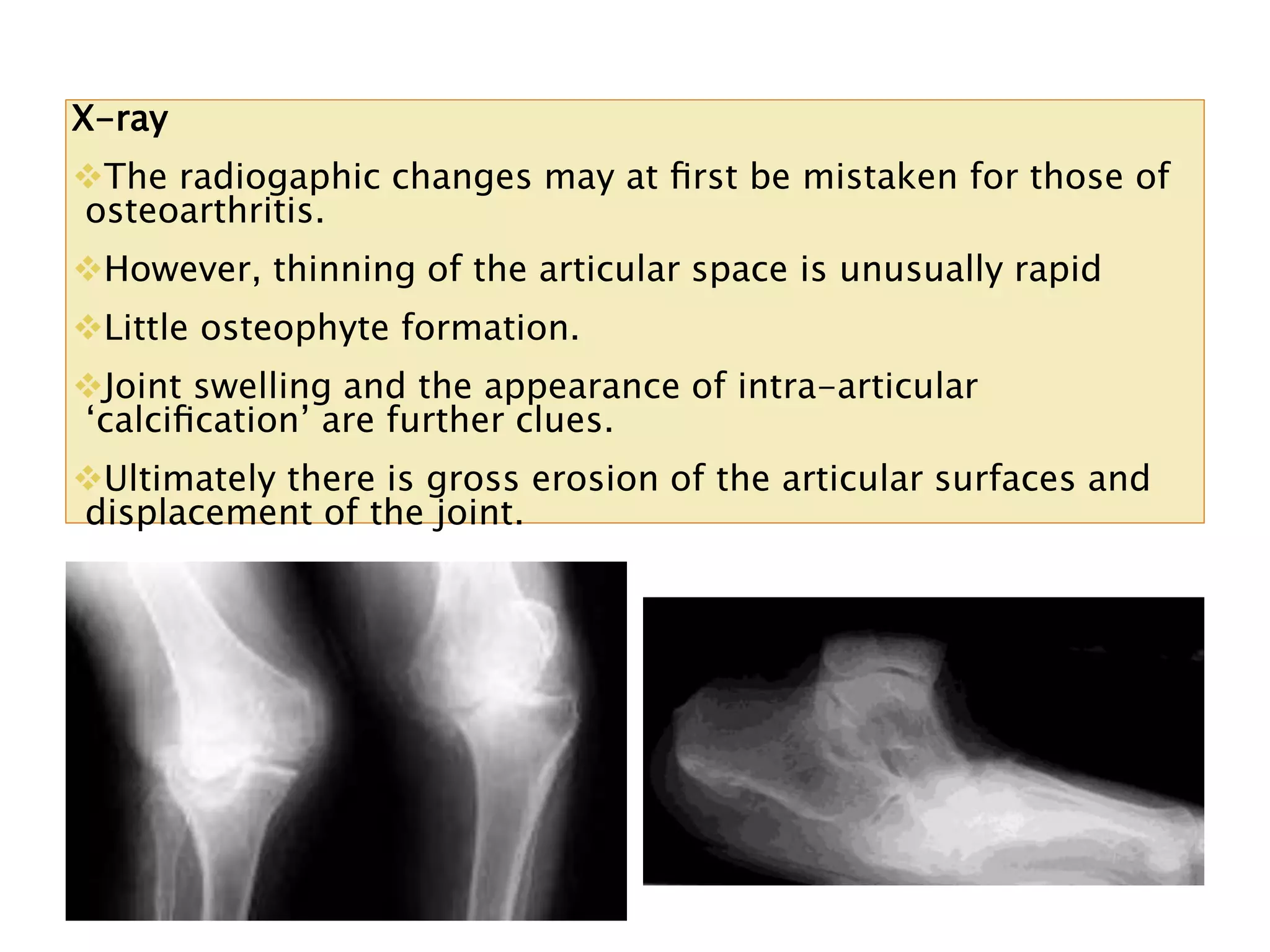 Osteoarthritis.pptx
