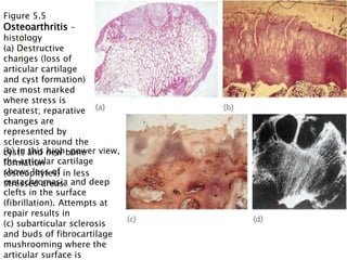Osteoarthritis.pptx