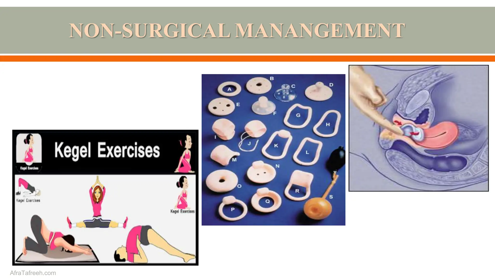 1-Pelvic Organ Prolapse atf.pdf obg and gyn | PPT