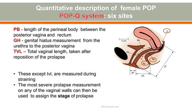 1-Pelvic Organ Prolapse atf.pdf obg and gyn | PPT