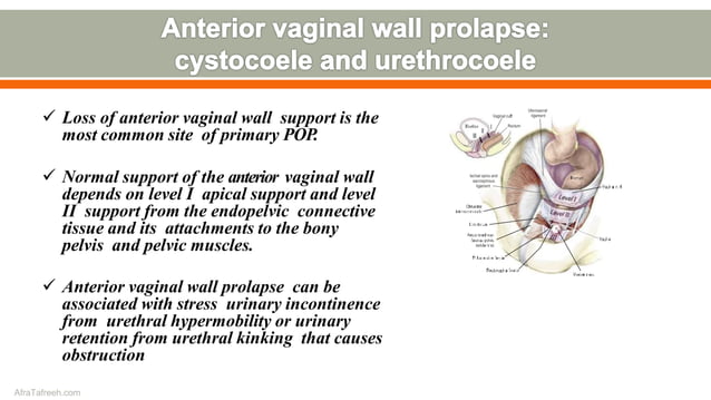 1-Pelvic Organ Prolapse atf.pdf obg and gyn | PPT