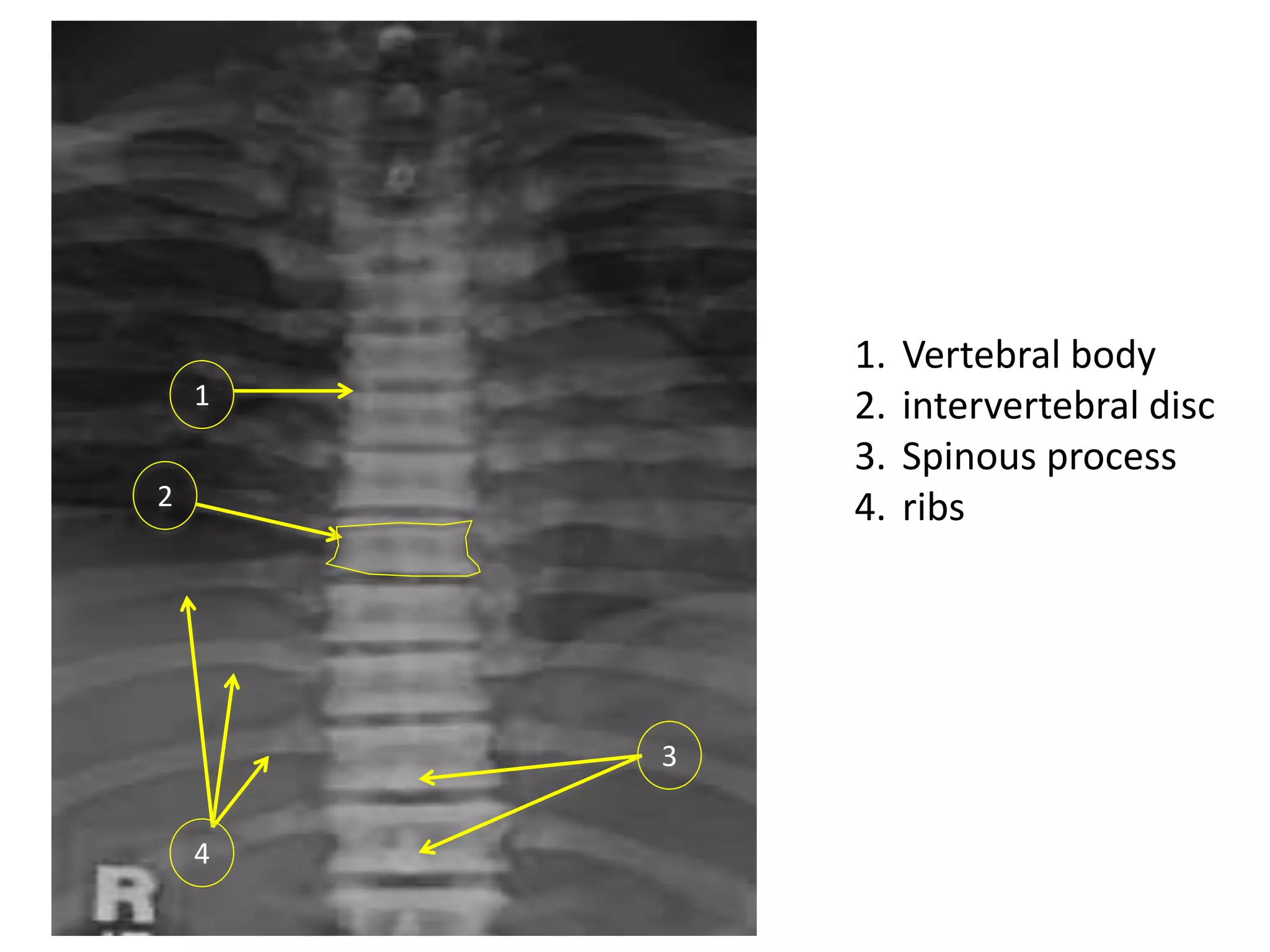1-Radiological anatomy of spine.ppt
