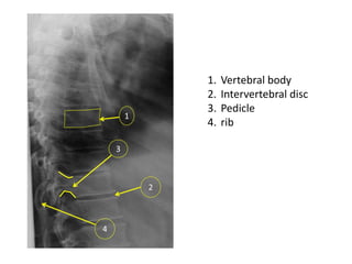 1-Radiological anatomy of spine.ppt