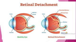 1-RETINAL-DETACHMENT (1).pptx perception in nursing | PPT