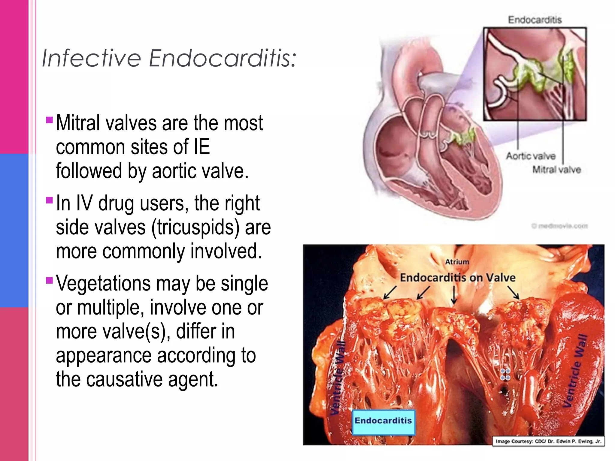 CVS Pathology 1 - Rheumatic heart disease, infective endocarditis and ...
