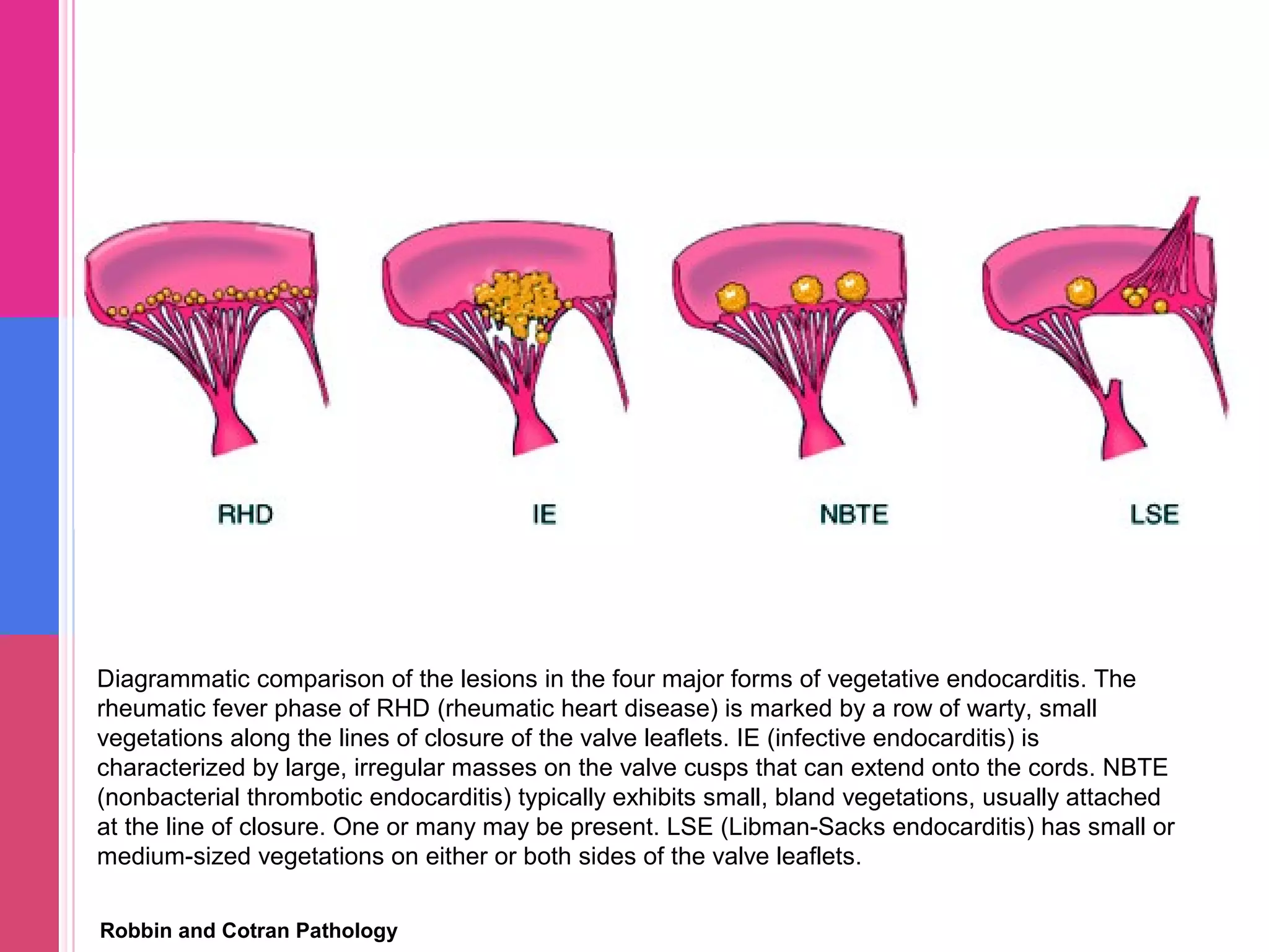 CVS Pathology 1 - Rheumatic heart disease, infective endocarditis and ...