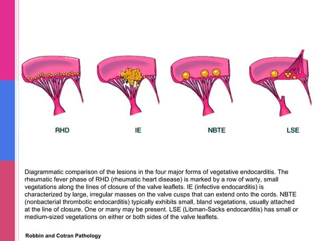 CVS Pathology 1 - Rheumatic heart disease, infective endocarditis and ...