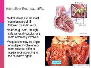 Infective Endocarditis Mitral Valve