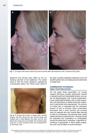 fractional co2 resurfacing has it replacer ablative resurfacin ...